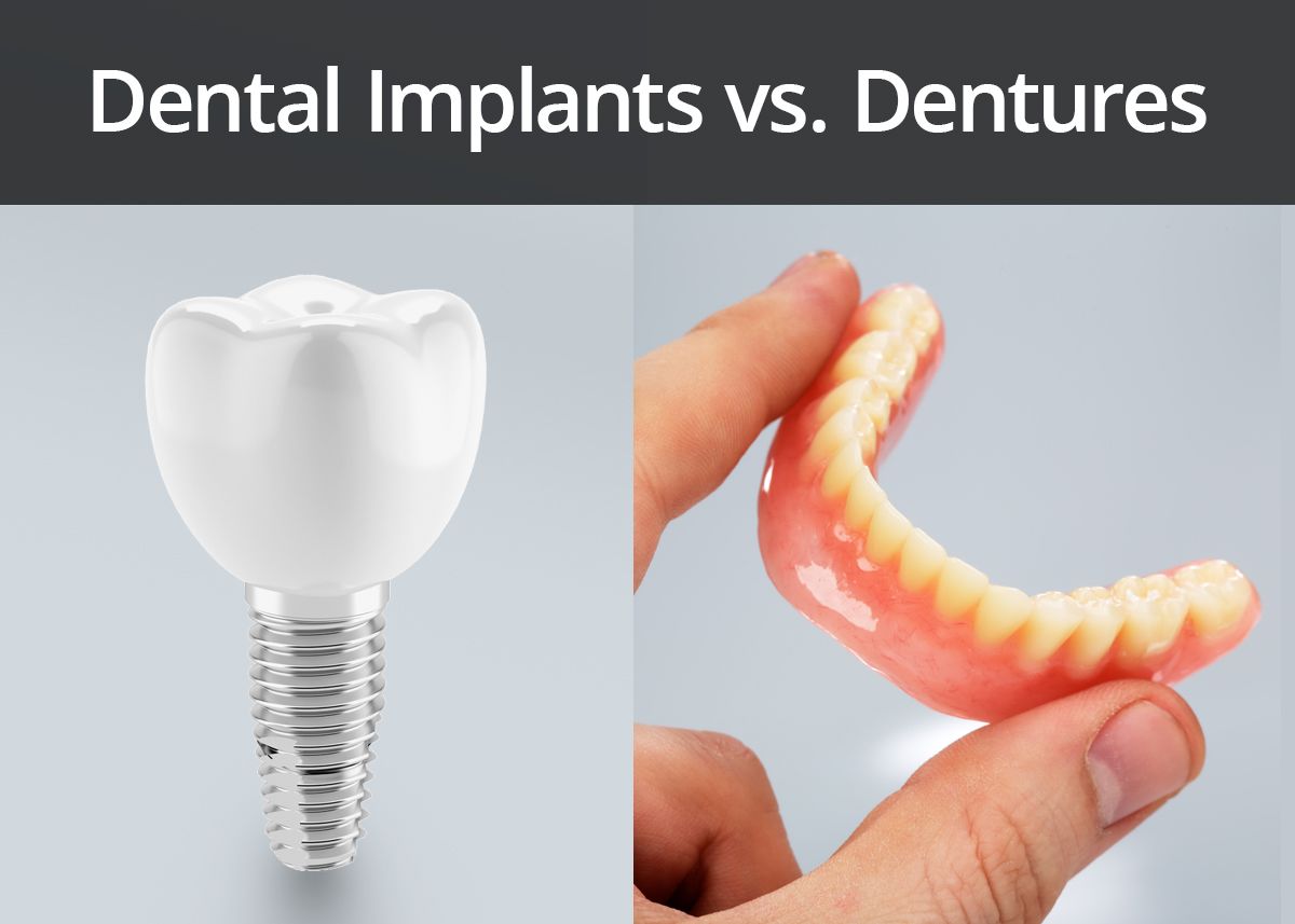 Implants vs Dentures: What's right for you? - Royal Dental Clinics Blog