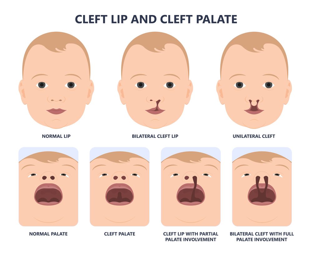 Cleft Lip Surgery Cost in India: A Comprehensive Guide