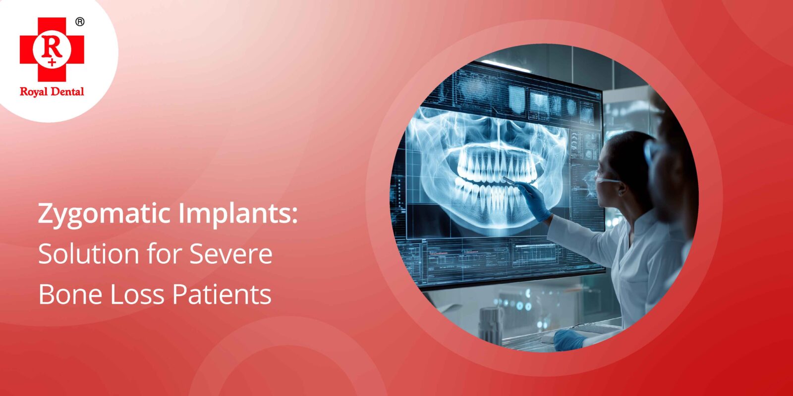 Zygomatic Implants for Patients with Severe Bone Loss | Royal Dental Clinic